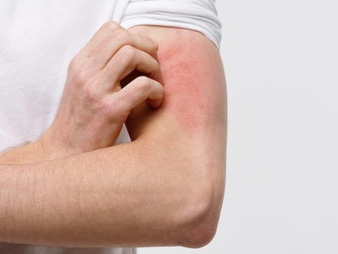 Acute and Chronic Hives and Rashes: Causes and Treatments - Brynna ...