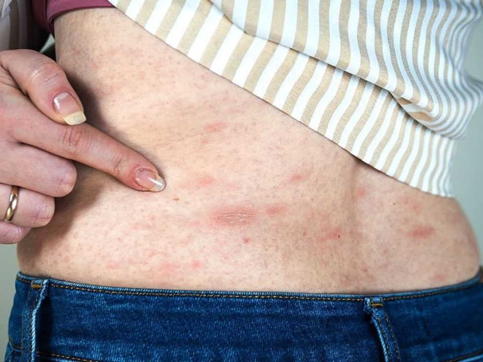 Acute and Chronic Hives and Rashes: Causes and Treatments - Brynna ...